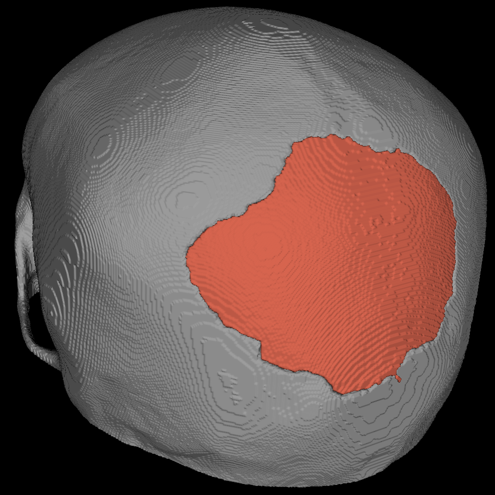 Point Cloud Diffusion Models for Automatic Implant Generation
