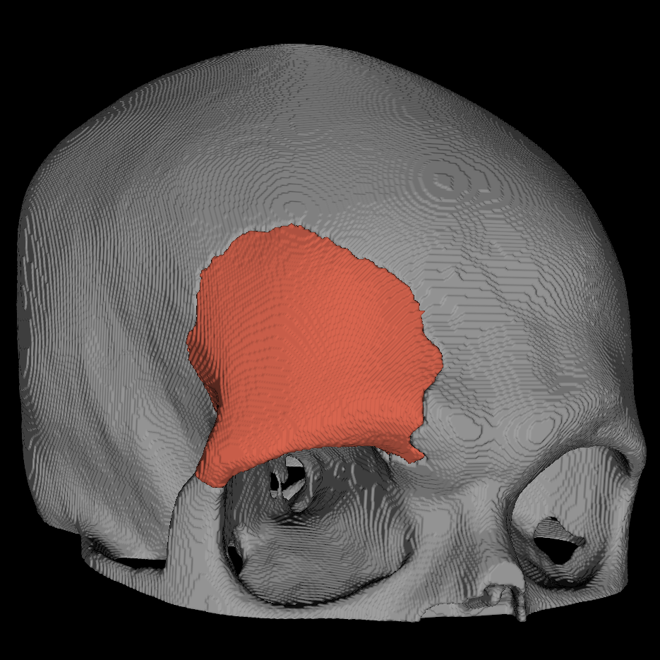 Point Cloud Diffusion Models for Automatic Implant Generation