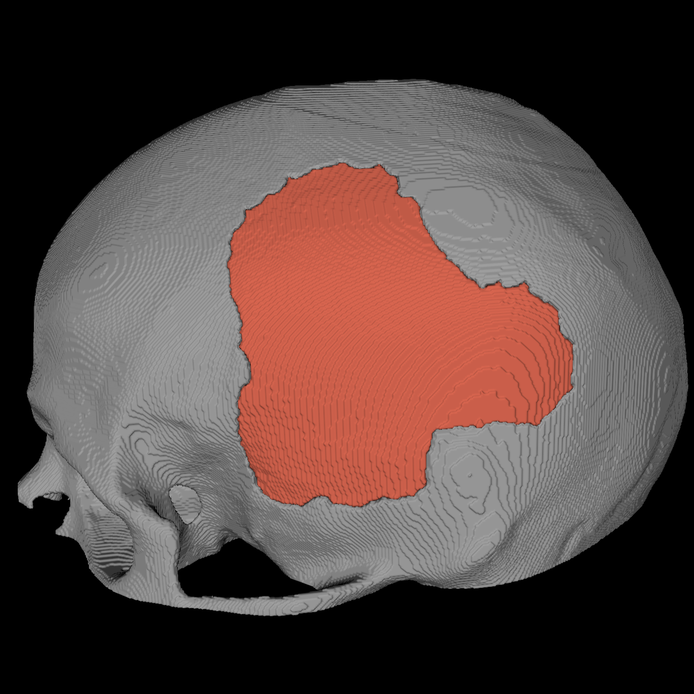 Point Cloud Diffusion Models for Automatic Implant Generation