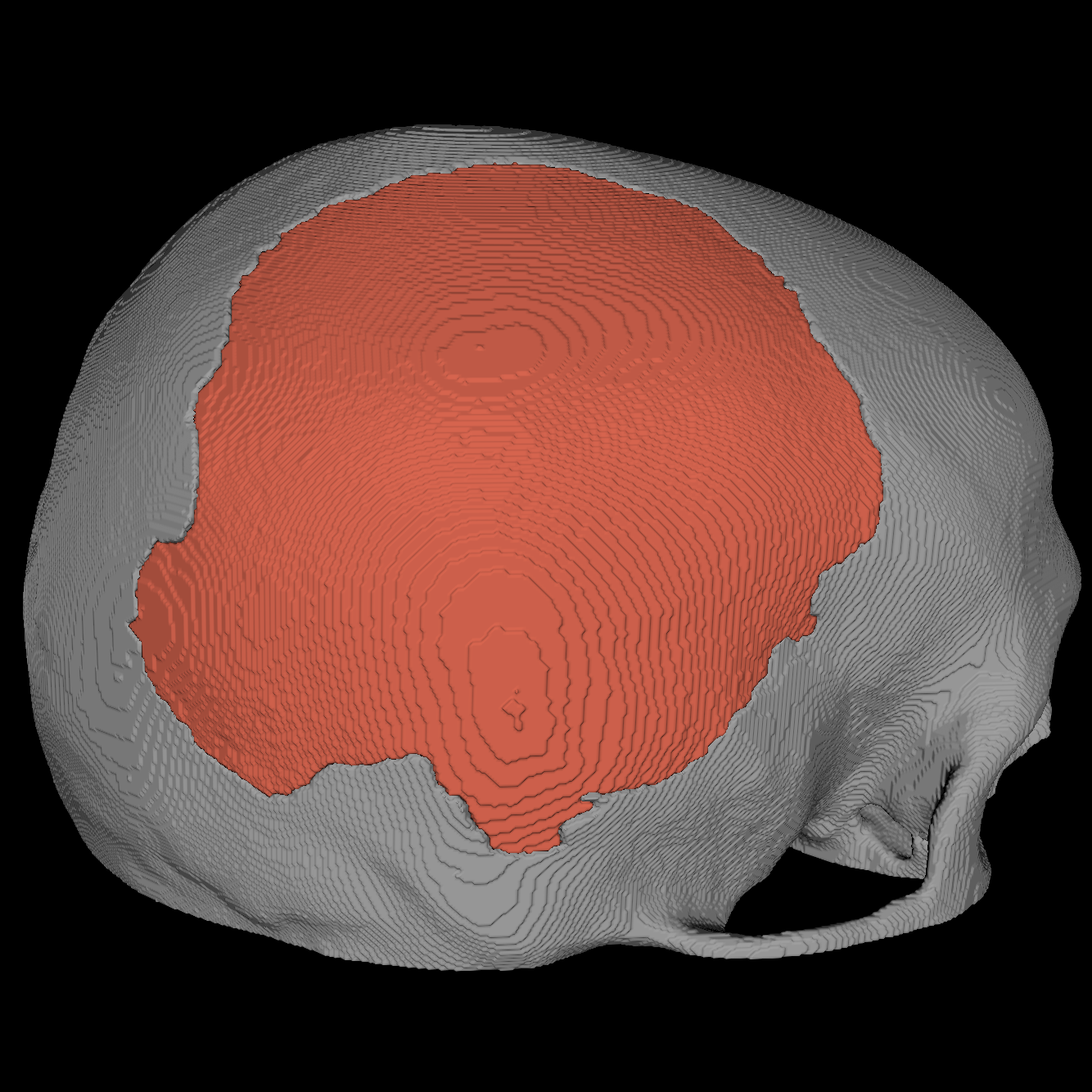 Point Cloud Diffusion Models for Automatic Implant Generation