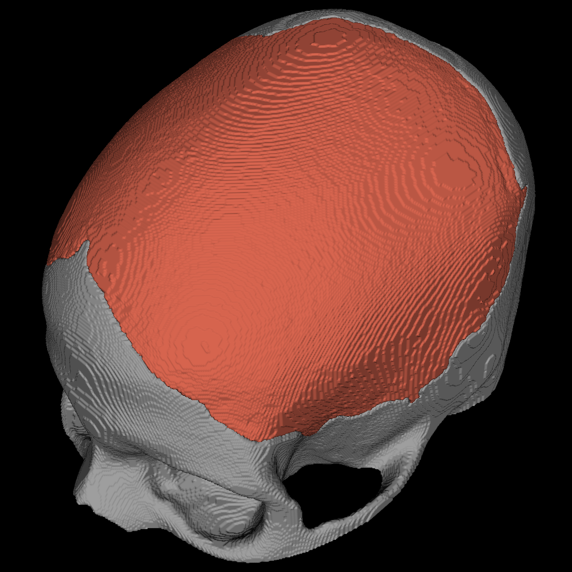 Point Cloud Diffusion Models for Automatic Implant Generation