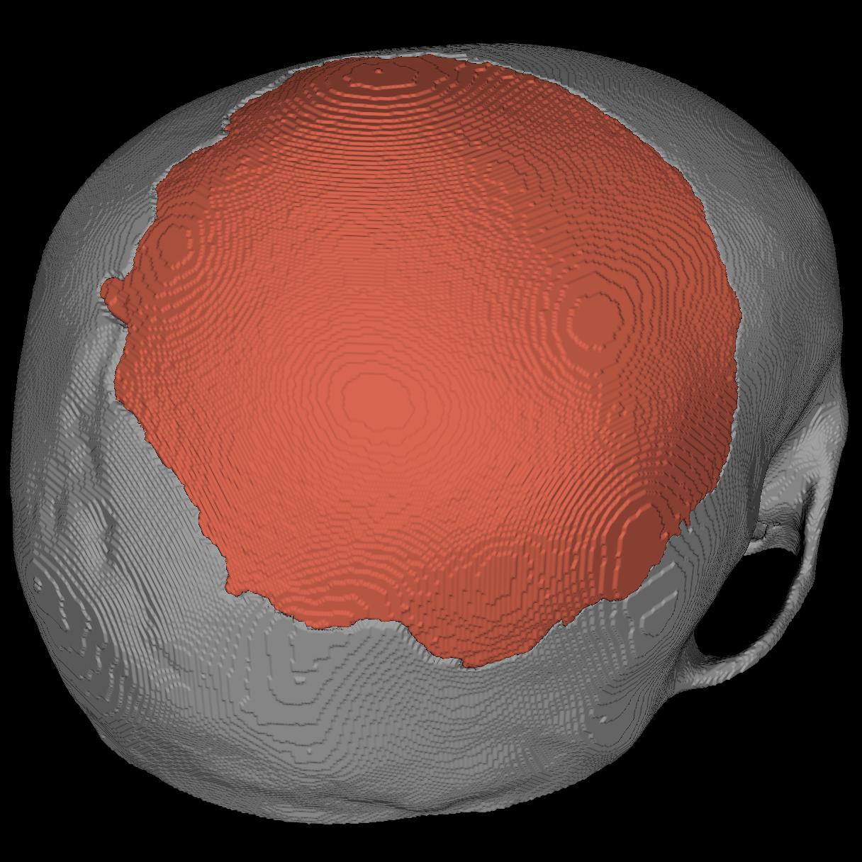 Point Cloud Diffusion Models for Automatic Implant Generation