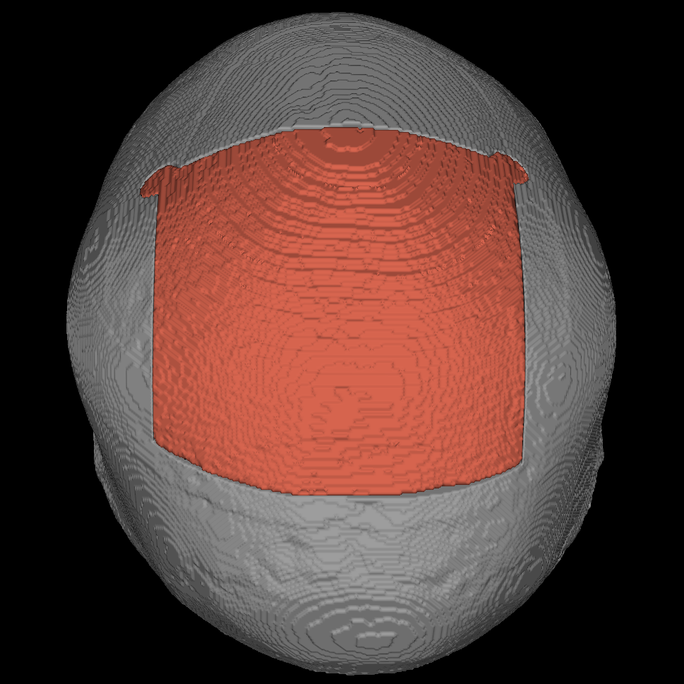 Point Cloud Diffusion Models for Automatic Implant Generation
