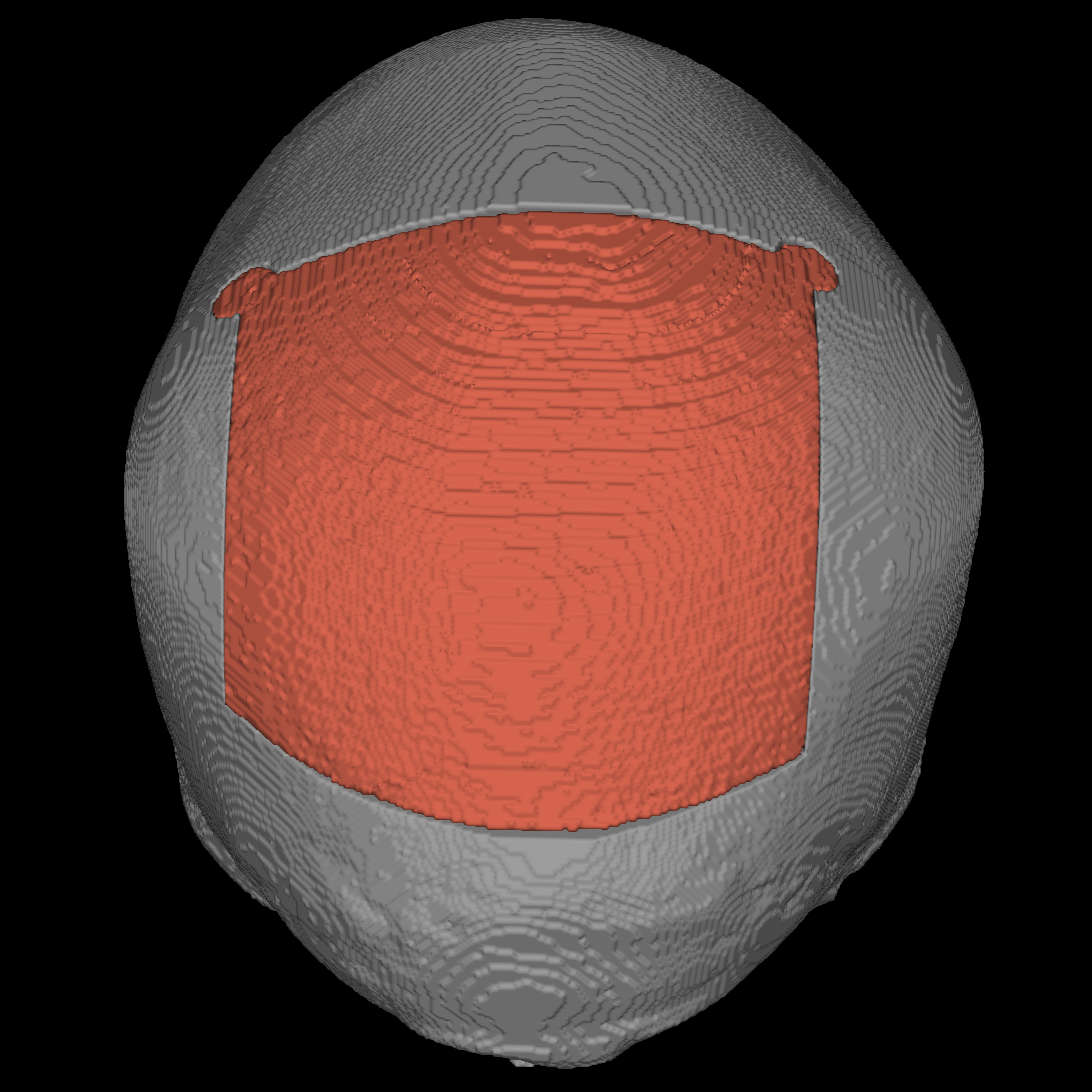 Point Cloud Diffusion Models for Automatic Implant Generation
